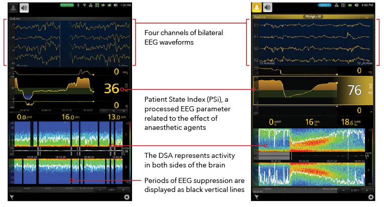Masimo - Next Generation SedLine® Brain Function Monitor